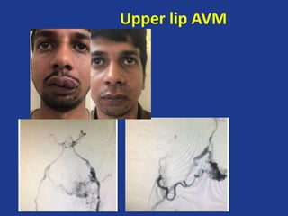 Vascular Anomalies: Vascular Tumours and Vascular malformations | PPTX