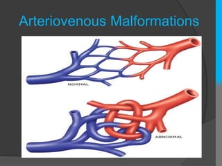Vascular malformations gc | PPT