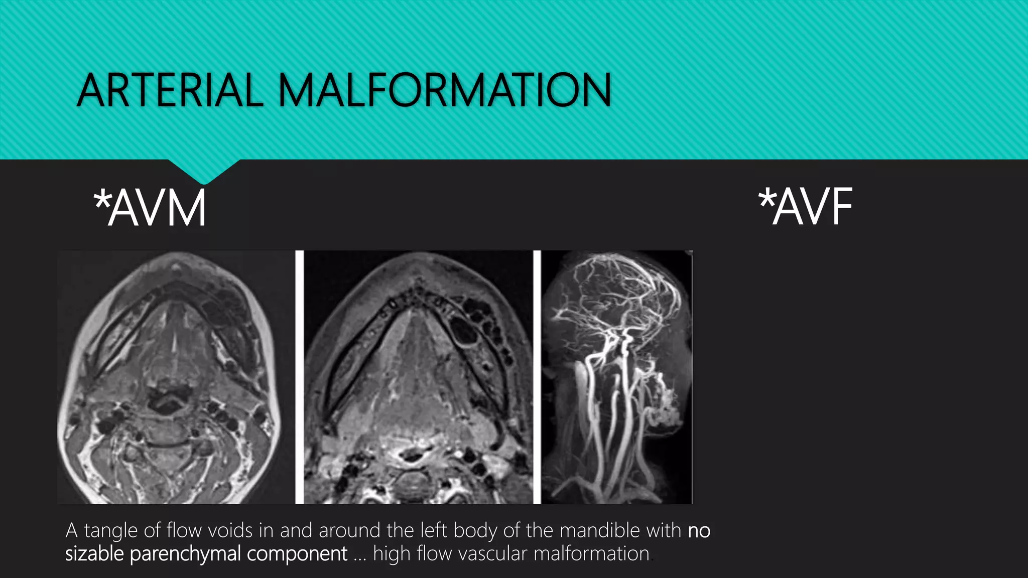 Vascular malformations of the head and neck | PPTX