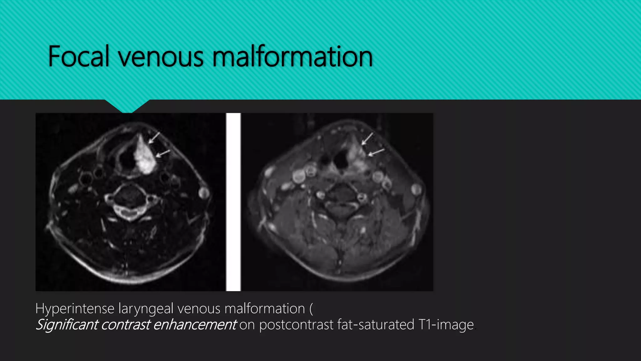 Vascular malformations of the head and neck | PPTX
