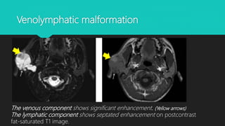 Vascular malformations of the head and neck | PPTX