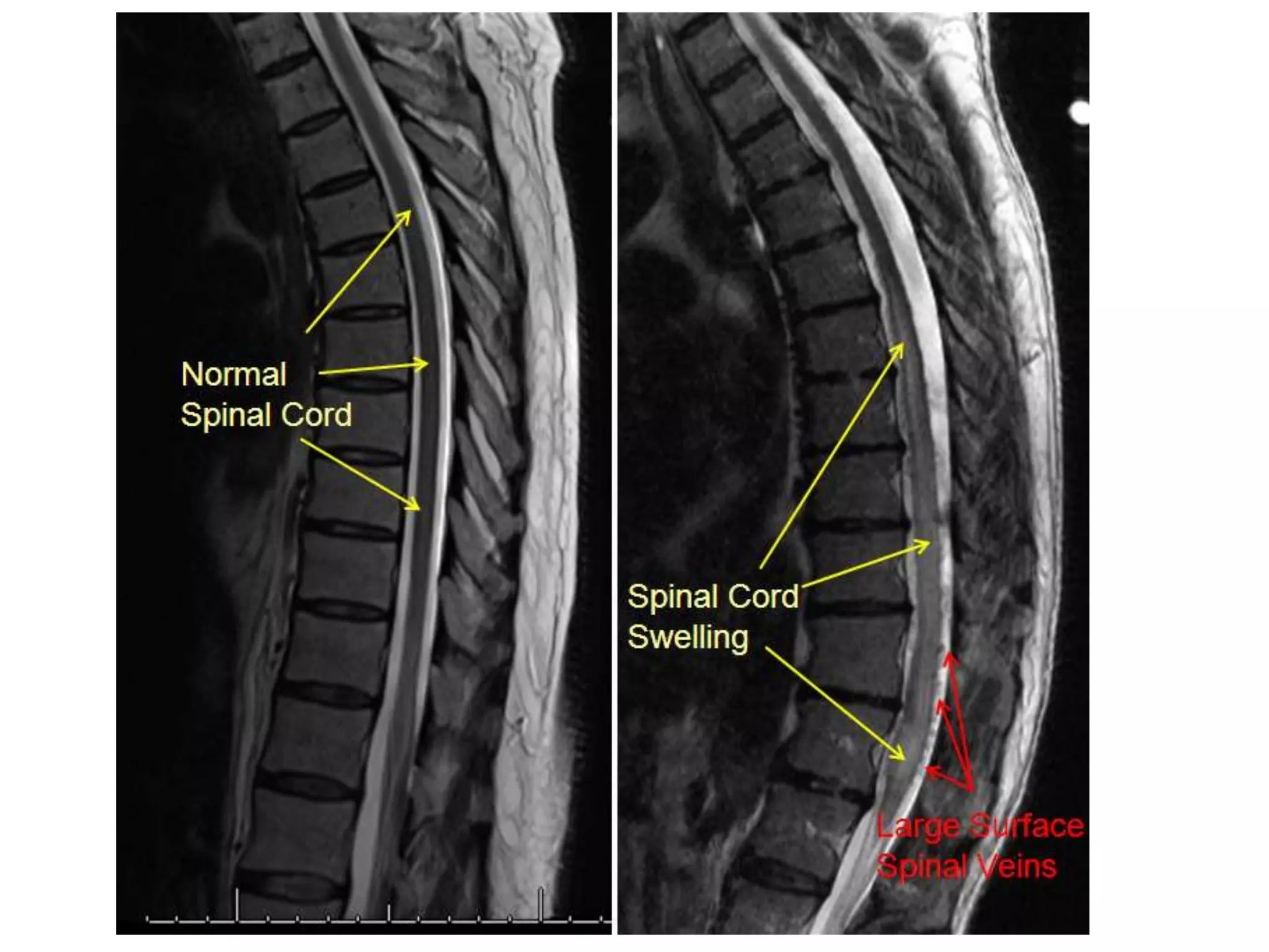 Vascular malformations of the spinal cord | PPT