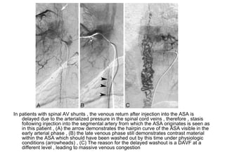 Vascular malformations of the spinal cord | PPT