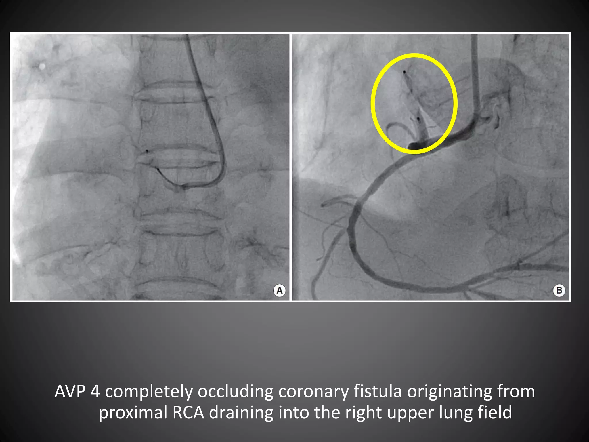 Use of Vascular plugs in cardiovascular medicine | PPTX
