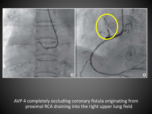 Use of Vascular plugs in cardiovascular medicine | PPT