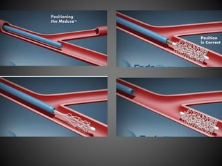 Use of Vascular plugs in cardiovascular medicine | PPTX
