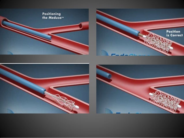 Use of Vascular plugs in cardiovascular medicine