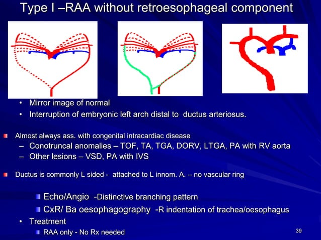 Vascular ring and sling | PPTX | Lung and Respiratory Health | Diseases ...