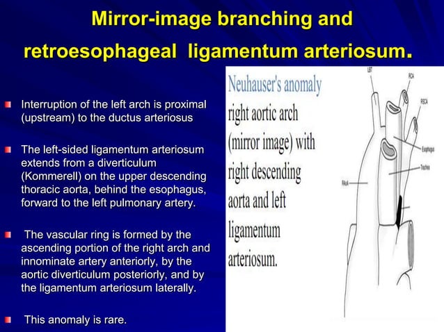 Vascular ring and sling | PPTX | Lung and Respiratory Health | Diseases ...