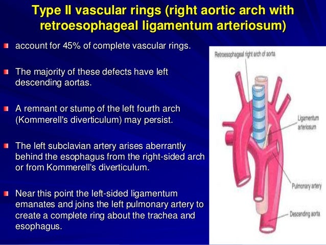 Vascular ring and sling