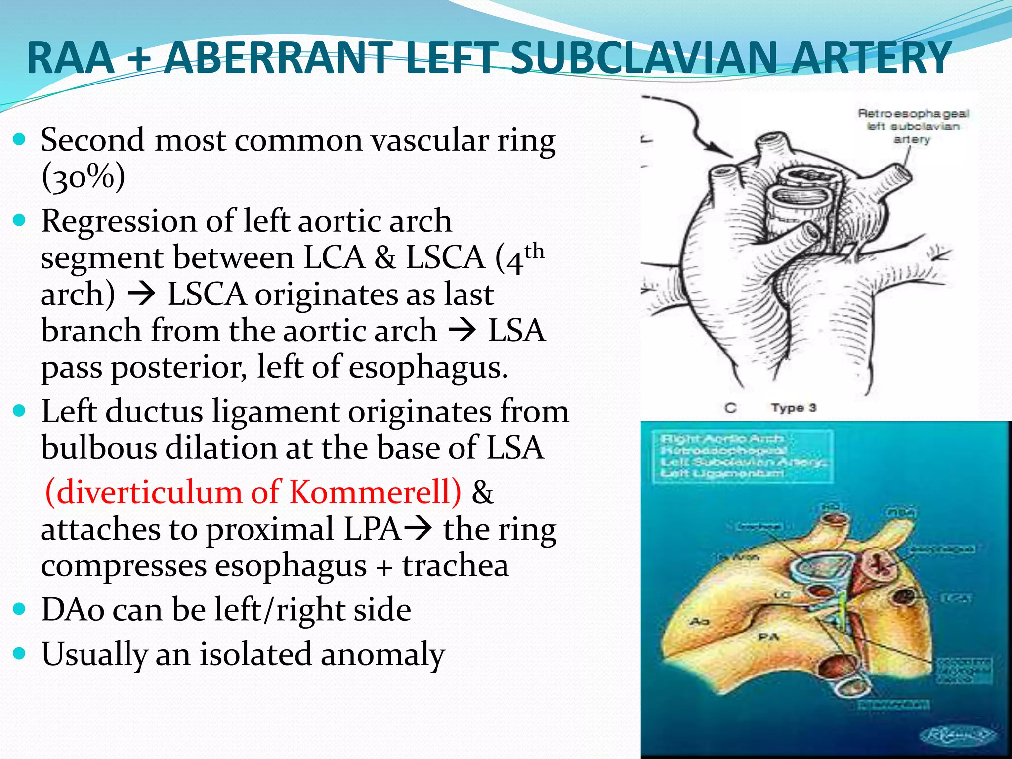 Vascular ring & Sling | PPTX