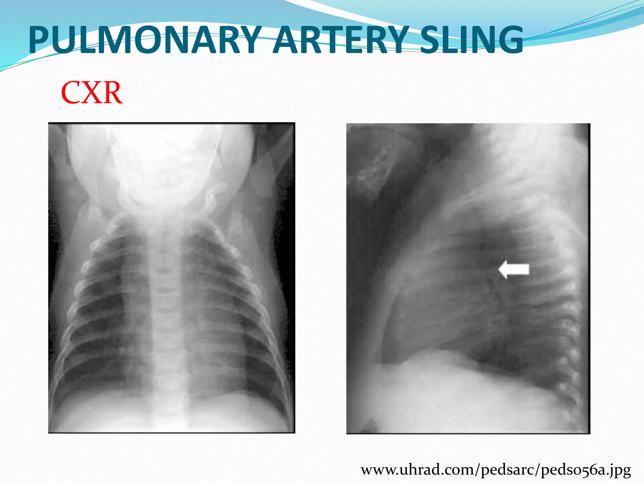 Vascular ring & Sling | PPTX
