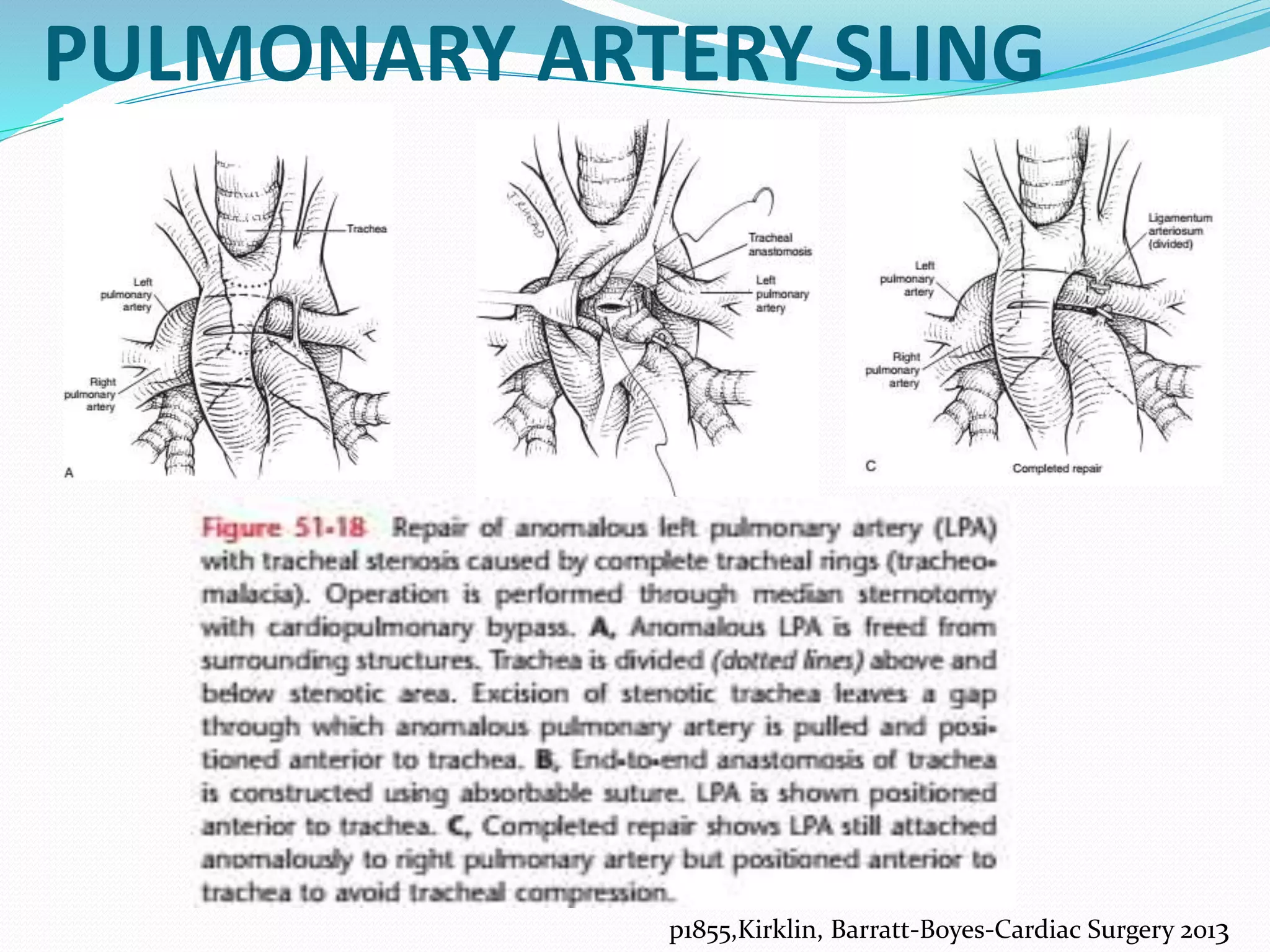 Vascular ring & Sling | PPTX