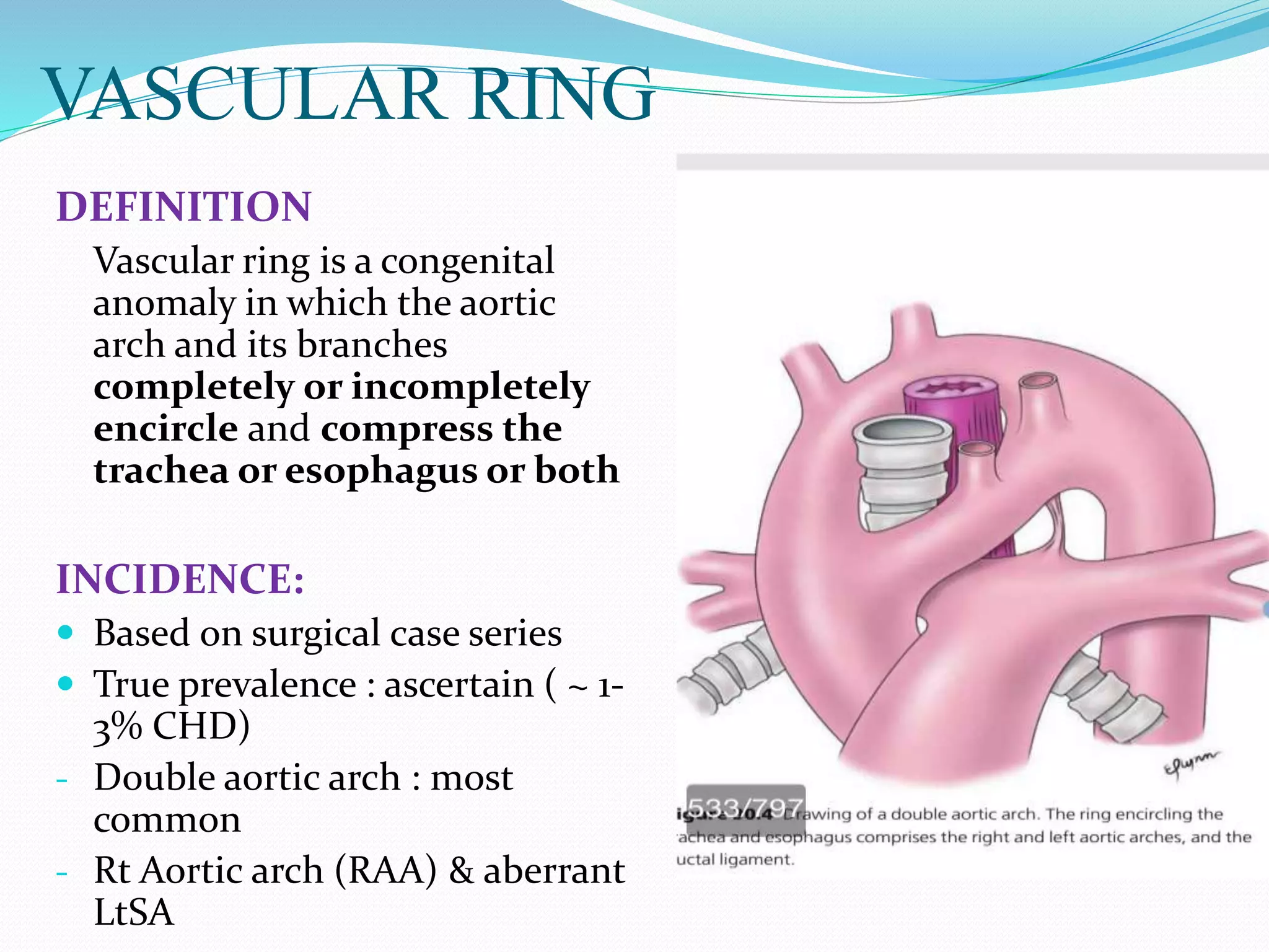 Vascular ring & Sling | PPTX