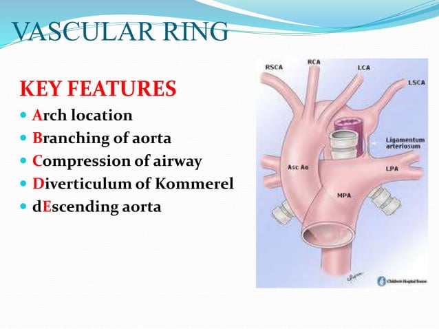 Vascular ring & Sling | PPTX