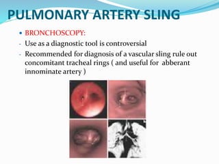 Vascular ring & Sling | PPTX