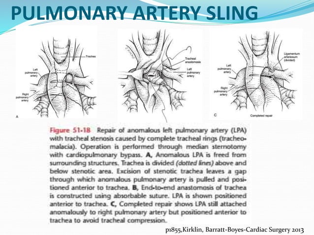 Vascular ring & Sling | PPTX