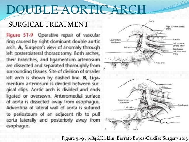 Vascular ring & Sling