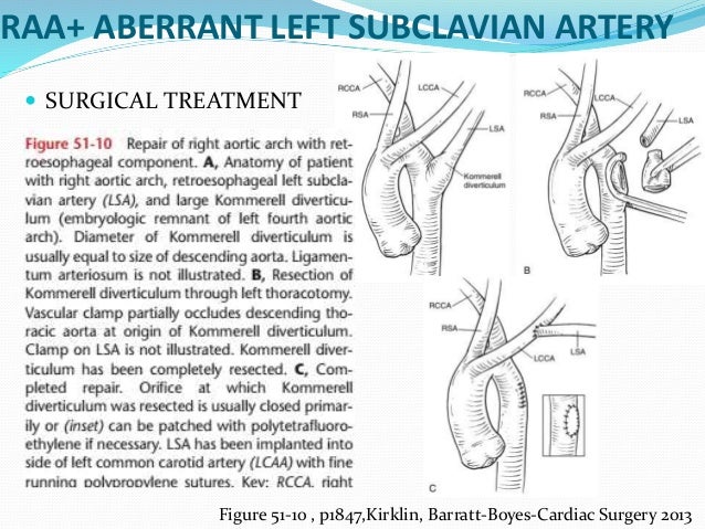 Vascular ring & Sling