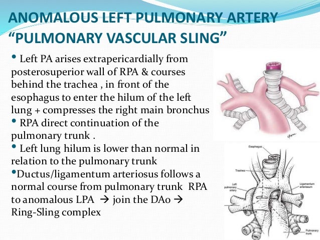Vascular ring & Sling