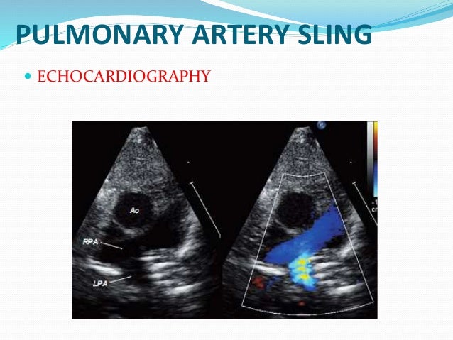 Vascular ring & Sling