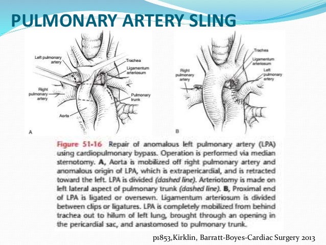 Vascular ring & Sling