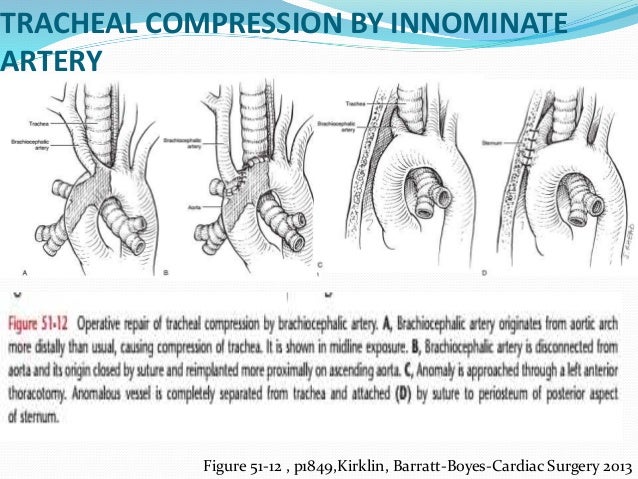 Vascular ring & Sling