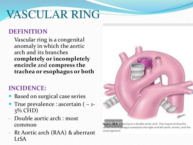Vascular ring & Sling | Vascular, Pediatrics, Cardiology