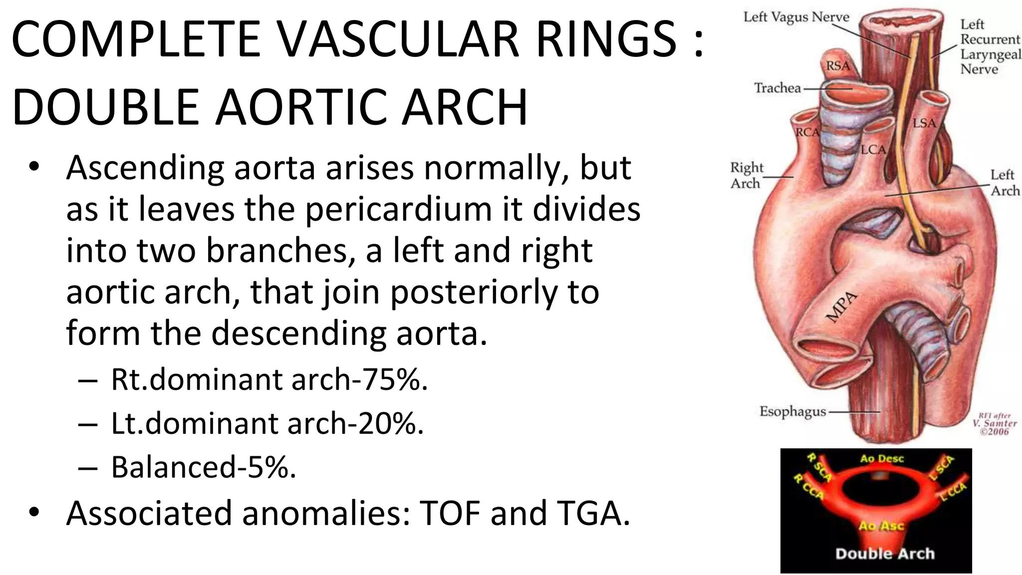 VASCULAR RINGS AND SLINGS TYPES HAEMODYNAMICS PRESENTATION AND ...