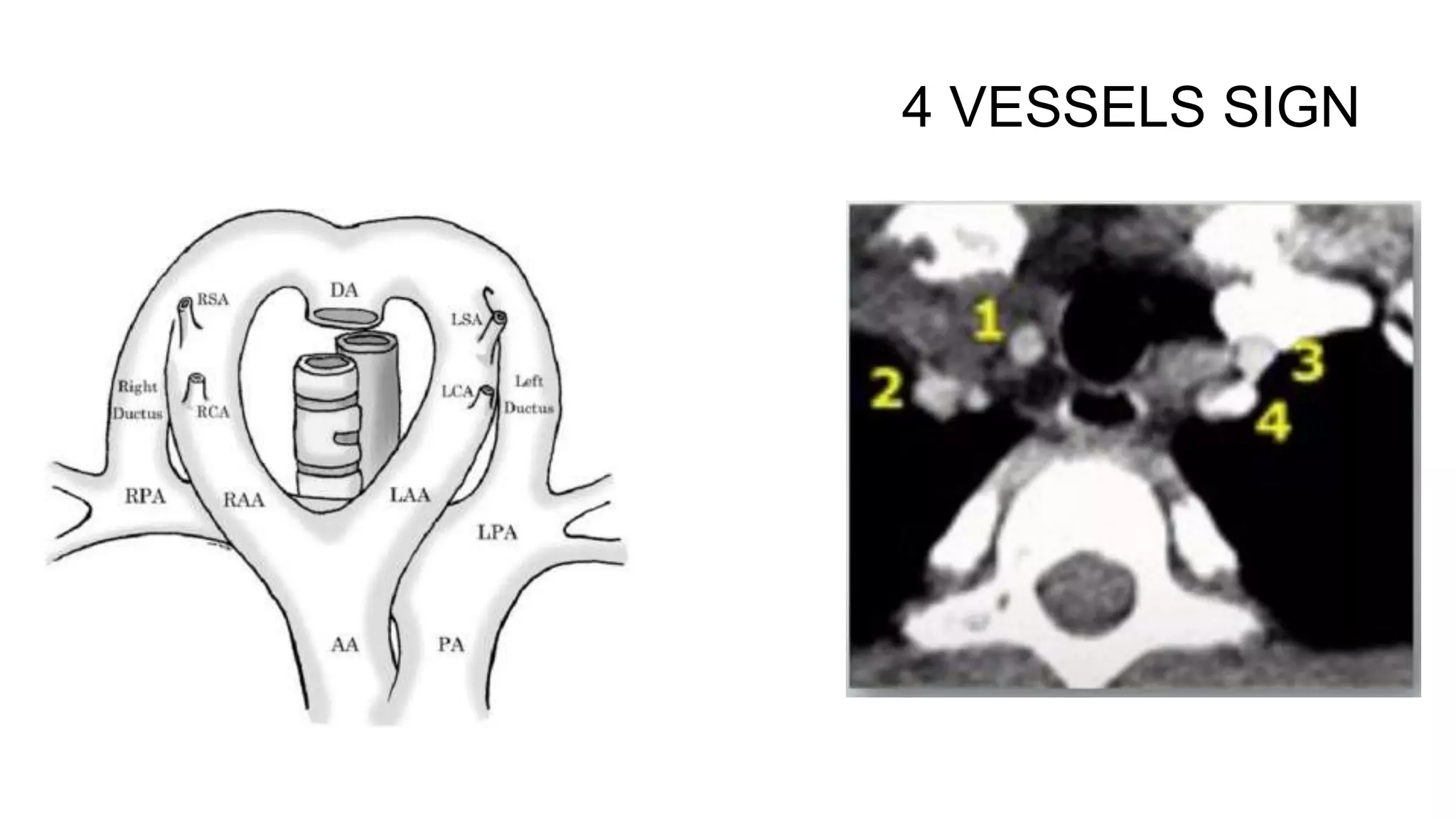VASCULAR RINGS AND SLINGS TYPES HAEMODYNAMICS PRESENTATION AND ...