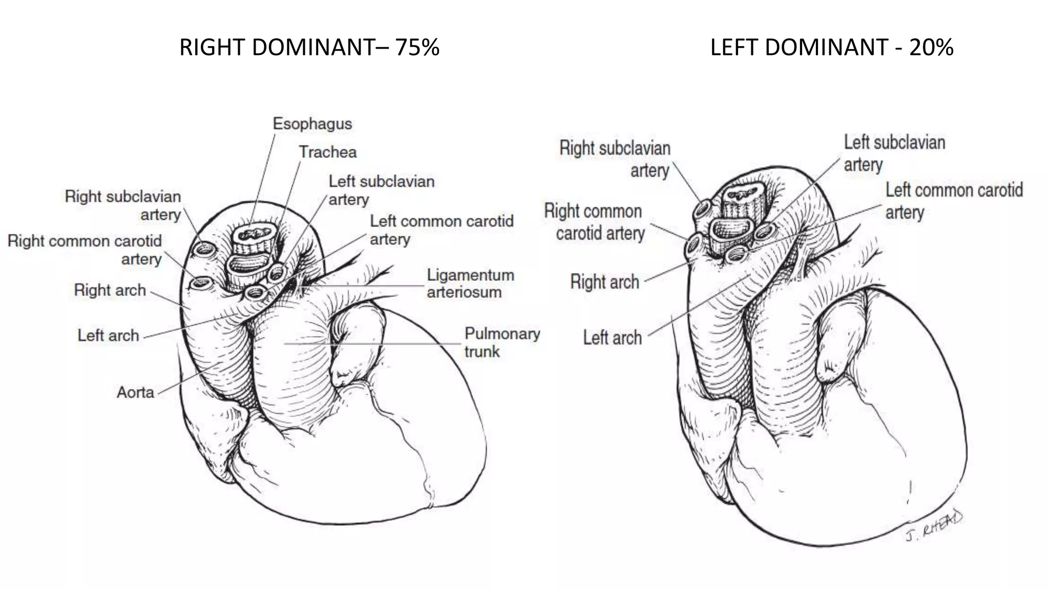 VASCULAR RINGS AND SLINGS TYPES HAEMODYNAMICS PRESENTATION AND ...