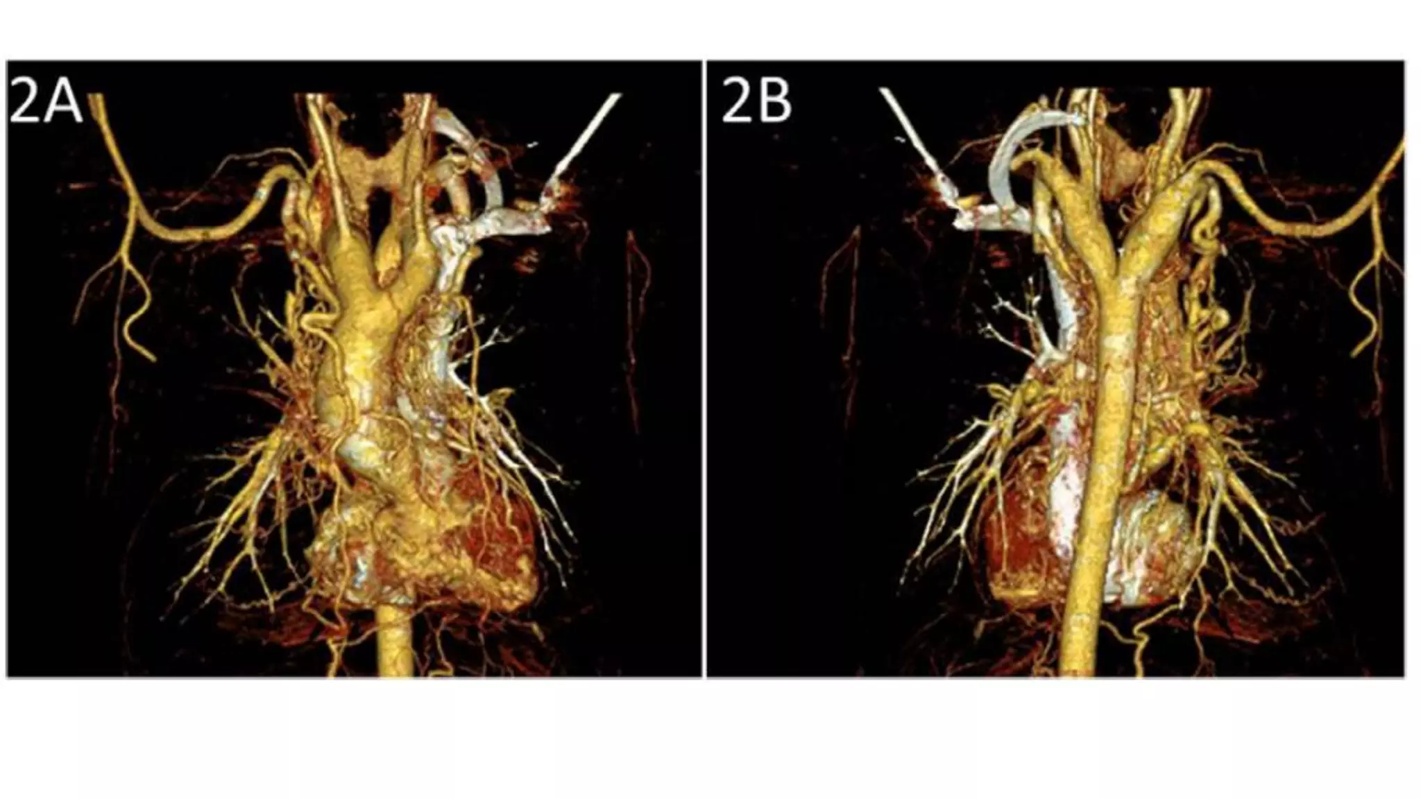 VASCULAR RINGS AND SLINGS TYPES HAEMODYNAMICS PRESENTATION AND ...
