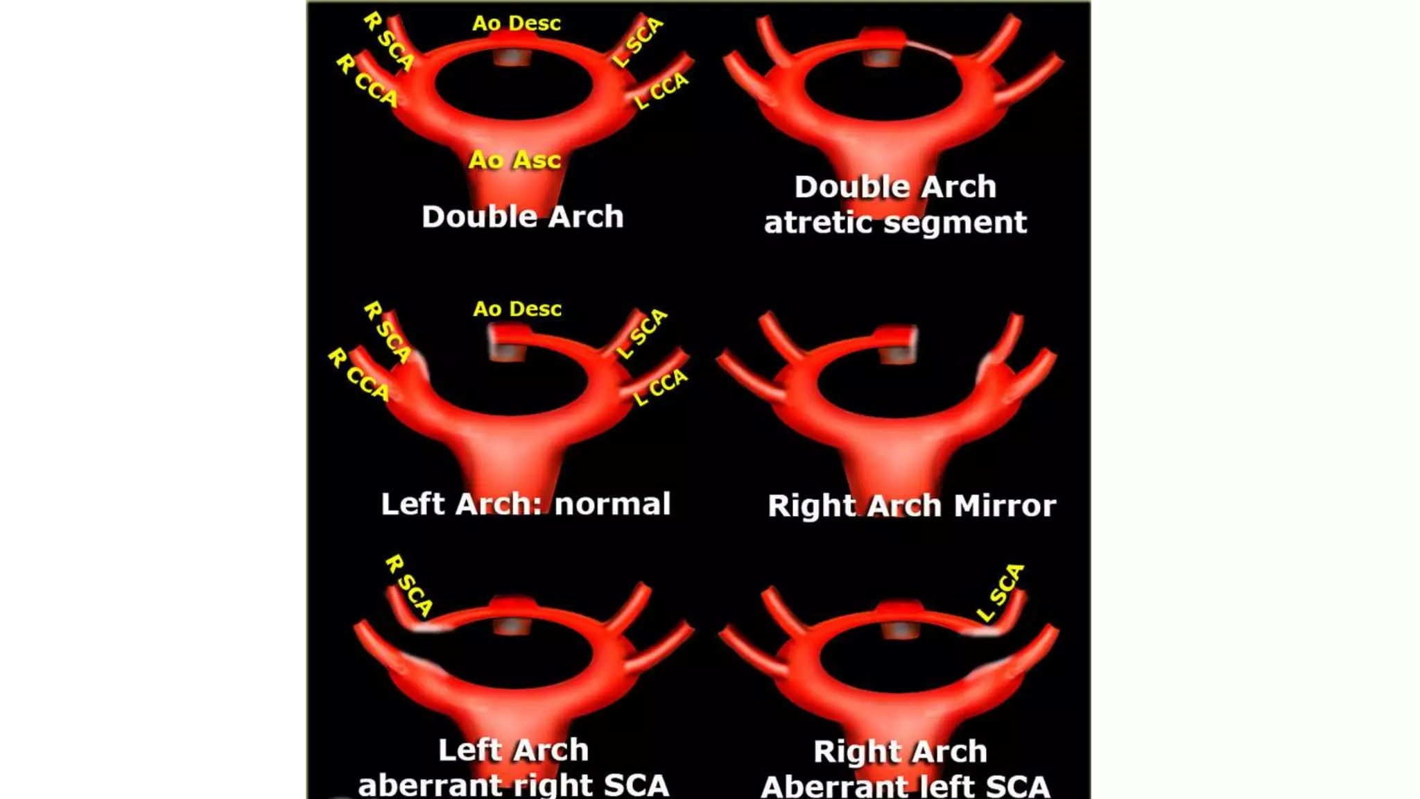 VASCULAR RINGS AND SLINGS TYPES HAEMODYNAMICS PRESENTATION AND ...