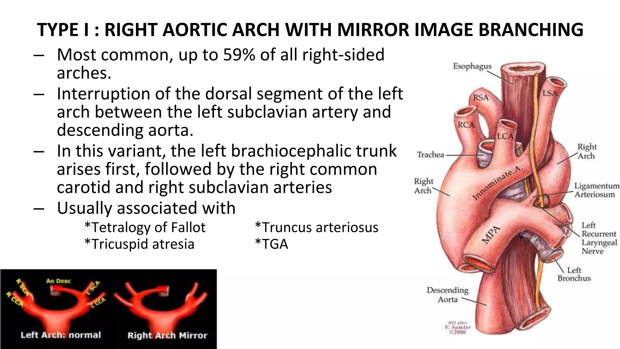 VASCULAR RINGS AND SLINGS TYPES HAEMODYNAMICS PRESENTATION AND ...