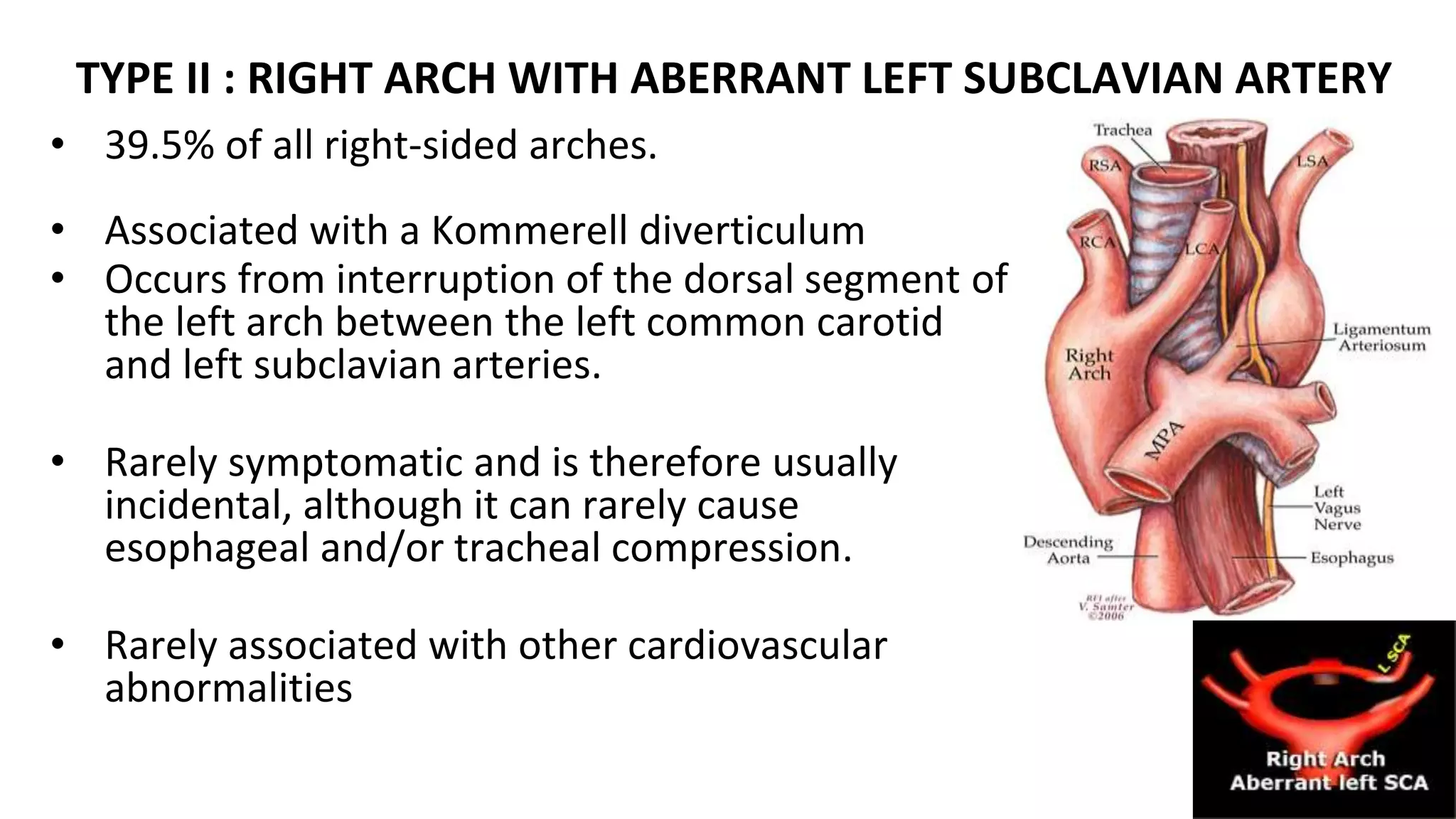 VASCULAR RINGS AND SLINGS TYPES HAEMODYNAMICS PRESENTATION AND ...