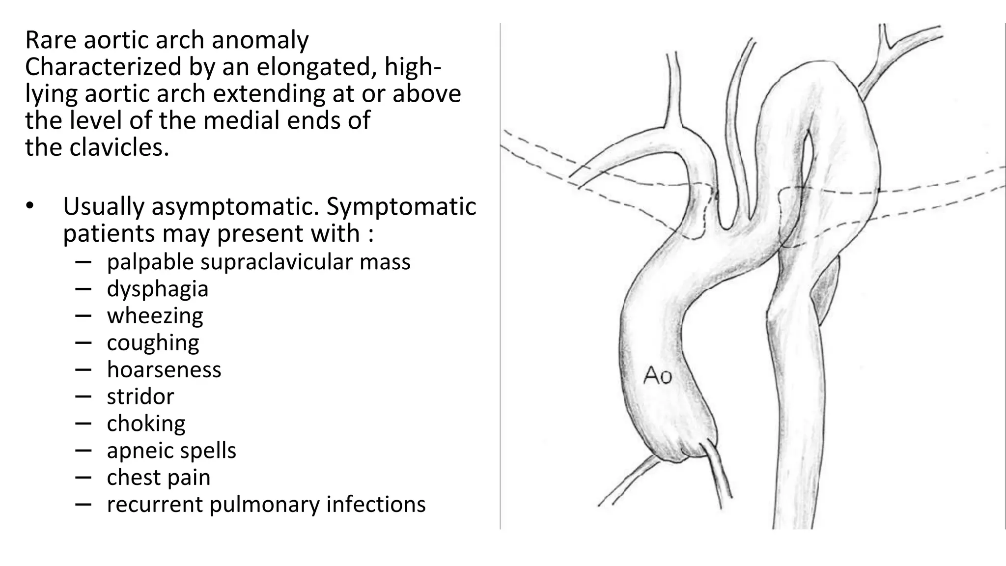 VASCULAR RINGS AND SLINGS TYPES HAEMODYNAMICS PRESENTATION AND ...