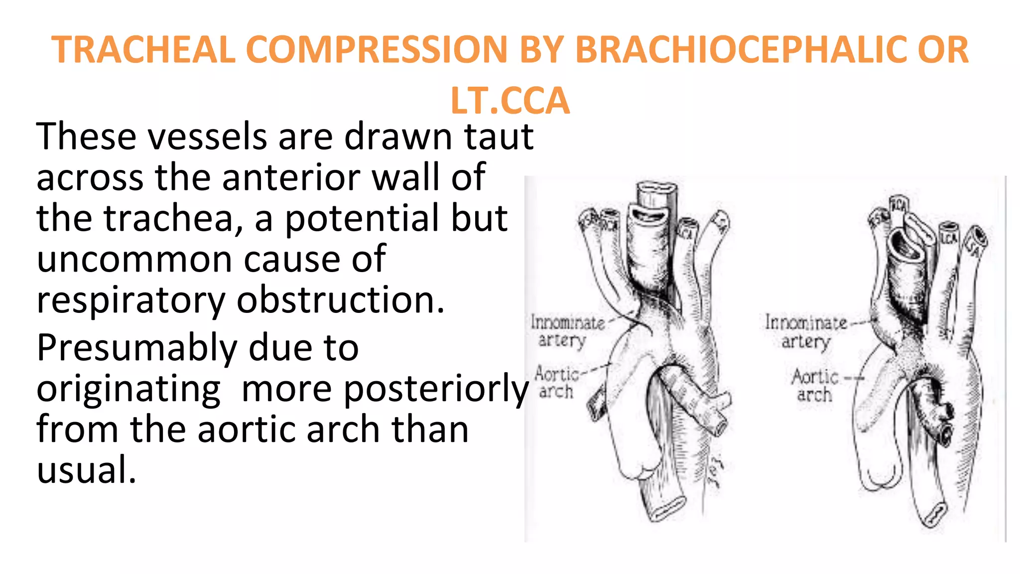 VASCULAR RINGS AND SLINGS TYPES HAEMODYNAMICS PRESENTATION AND ...