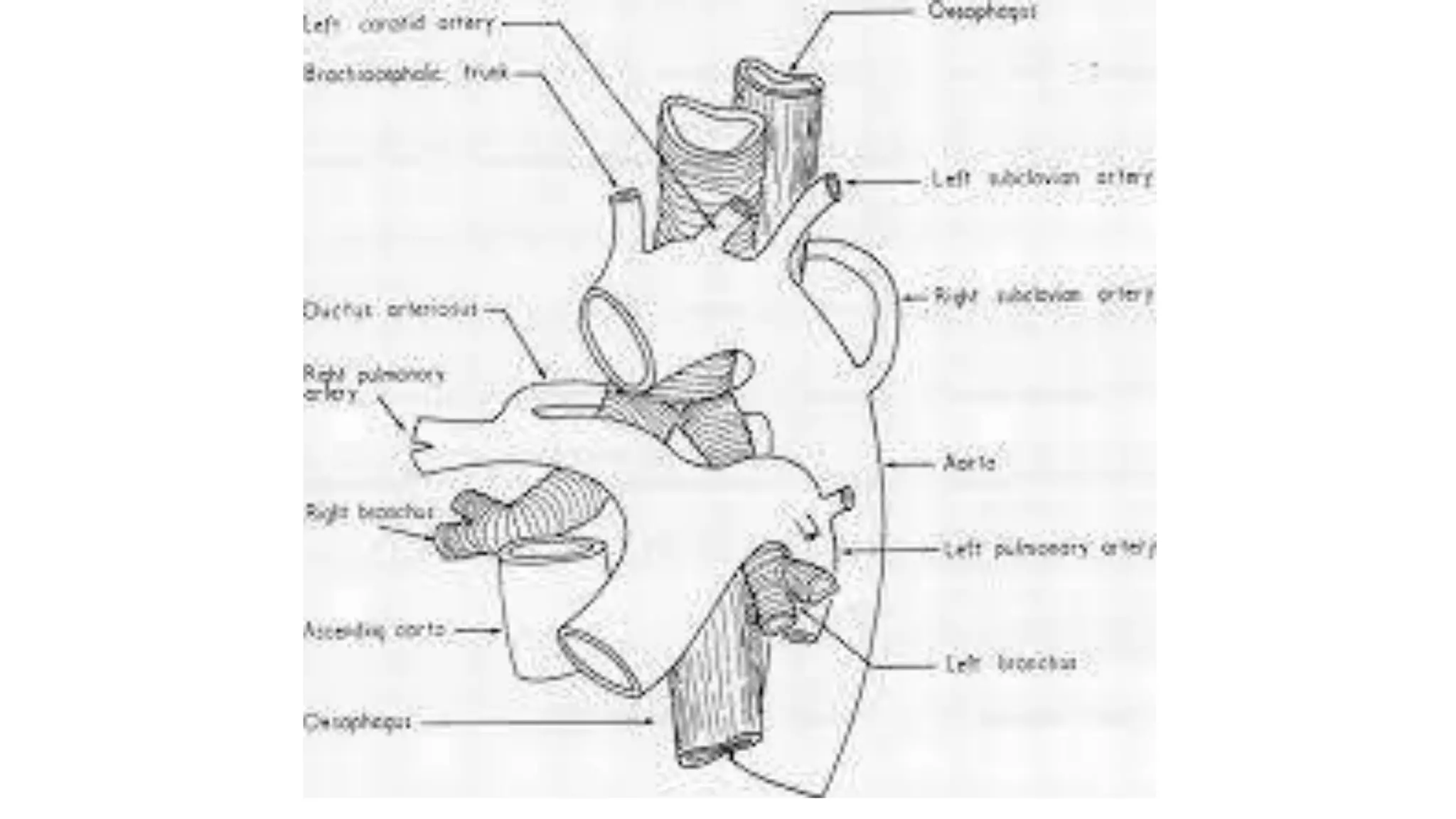 VASCULAR RINGS AND SLINGS TYPES HAEMODYNAMICS PRESENTATION AND ...
