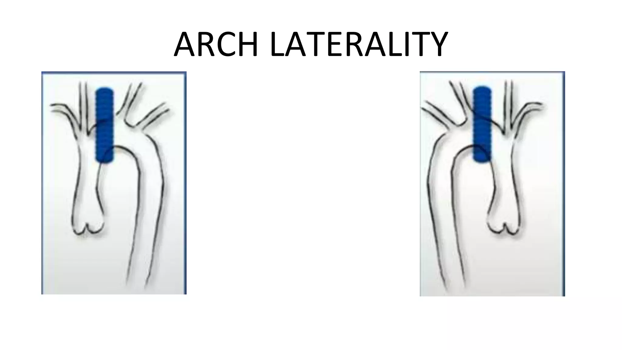VASCULAR RINGS AND SLINGS TYPES HAEMODYNAMICS PRESENTATION AND ...