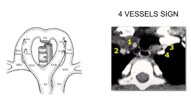 VASCULAR RINGS AND SLINGS TYPES HAEMODYNAMICS PRESENTATION AND ...
