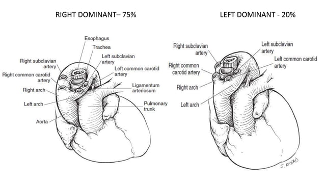 VASCULAR RINGS AND SLINGS TYPES HAEMODYNAMICS PRESENTATION AND ...
