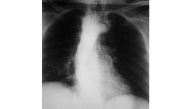 VASCULAR RINGS AND SLINGS TYPES HAEMODYNAMICS PRESENTATION AND ...