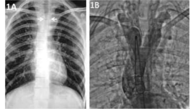 VASCULAR RINGS AND SLINGS TYPES HAEMODYNAMICS PRESENTATION AND ...