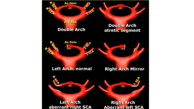 VASCULAR RINGS AND SLINGS TYPES HAEMODYNAMICS PRESENTATION AND ...