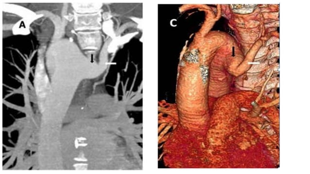 VASCULAR RINGS AND SLINGS TYPES HAEMODYNAMICS PRESENTATION AND ...
