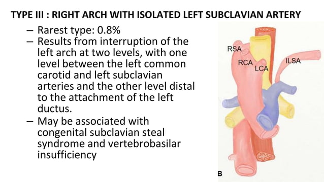 VASCULAR RINGS AND SLINGS TYPES HAEMODYNAMICS PRESENTATION AND ...