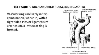 VASCULAR RINGS AND SLINGS TYPES HAEMODYNAMICS PRESENTATION AND ...