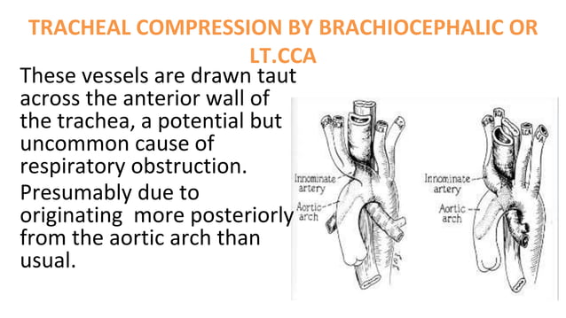 VASCULAR RINGS AND SLINGS TYPES HAEMODYNAMICS PRESENTATION AND ...