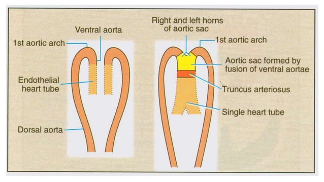 VASCULAR RINGS AND SLINGS TYPES HAEMODYNAMICS PRESENTATION AND ...