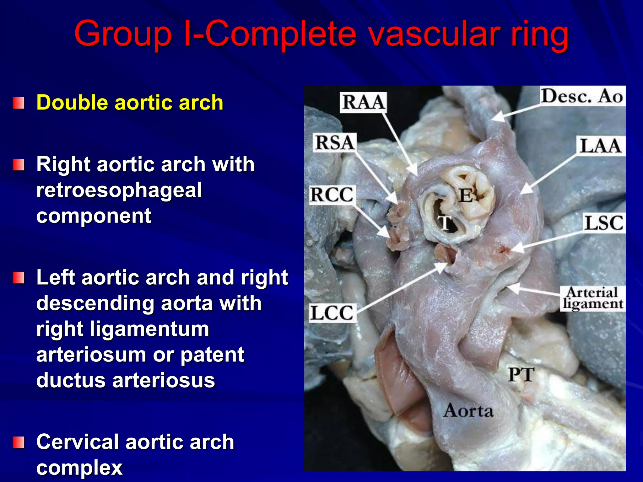 Vascular rings & slings | PPTX